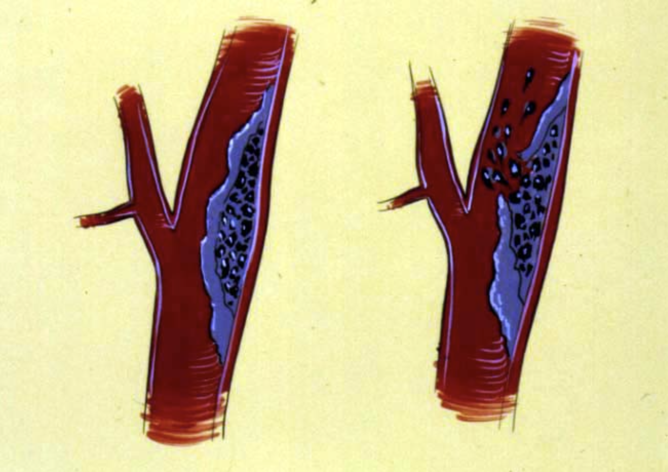 Carotid Artery Disease - Melbourne Vascular